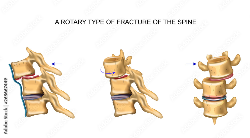 rotational type of vertebral fracture Stock Vector | Adobe Stock