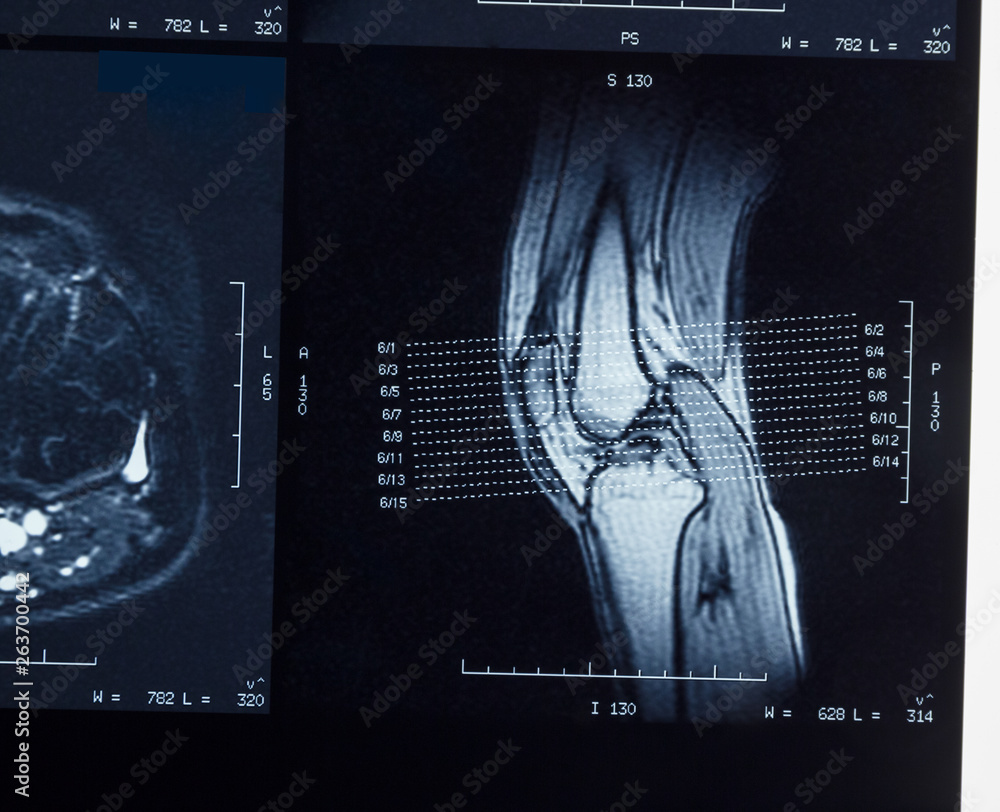 R.M.N. Nuclear magnetic resonance, of human knees, with cross-section ...