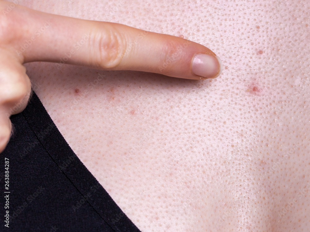 Blackheads On Breast