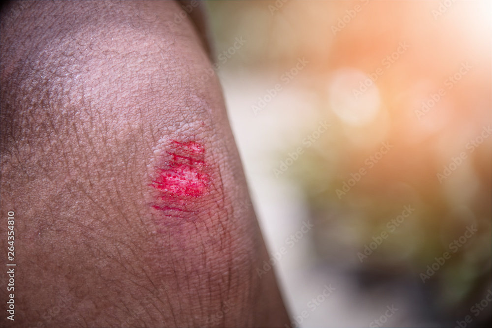 Knee wound from fall and bleeding Stock Photo | Adobe Stock