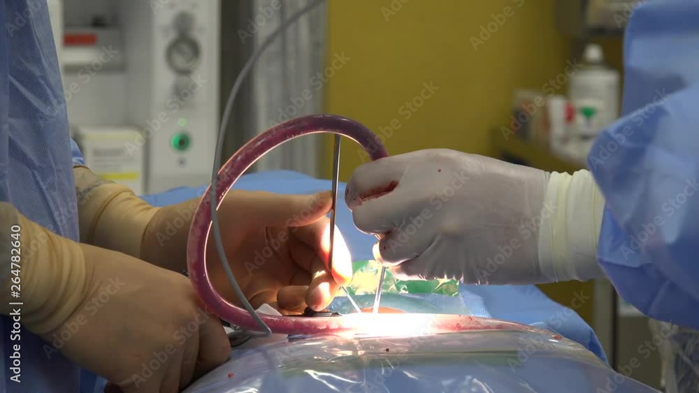 Minimally invasive spine surgery, also known as MISS, has no specific ...