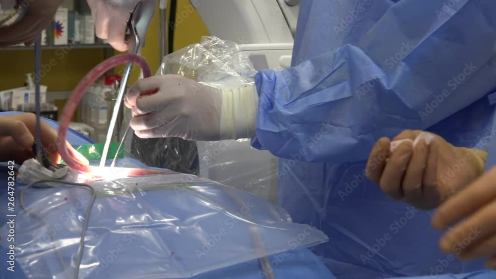 Minimally invasive spine surgery, also known as MISS, has no specific ...