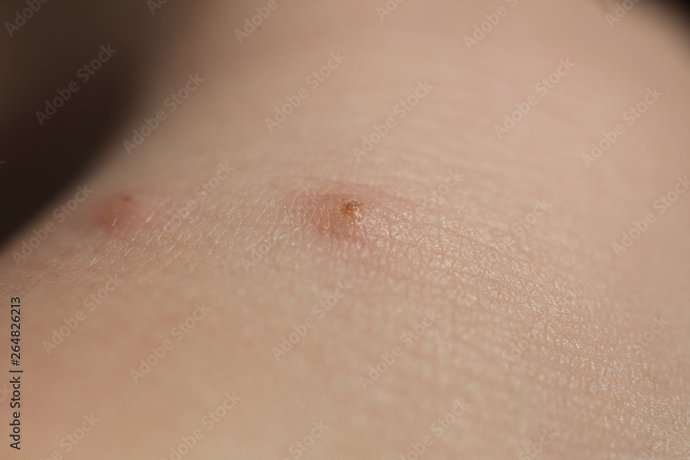 insect bites on skin child Stock Photo | Adobe Stock