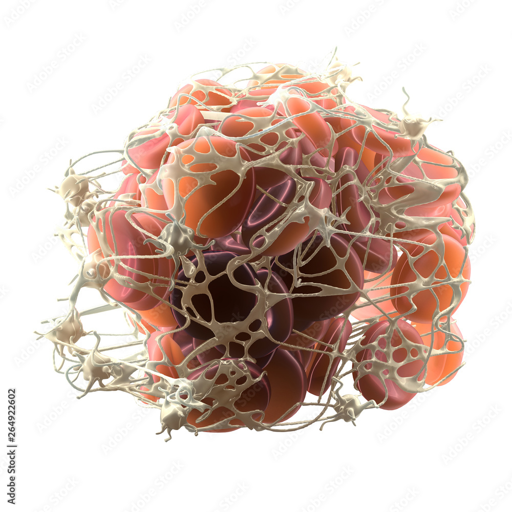 Thrombus in bloodstream, blood clot with activated platelets and fibrin ...