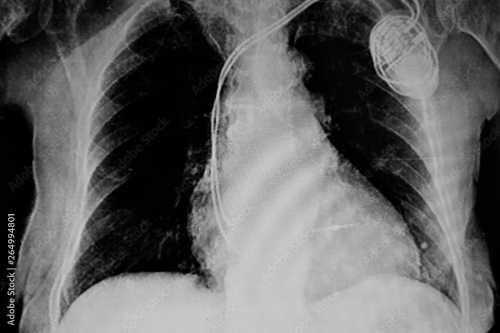 Chest X- Ray of a male patient with heart pacemaker and right lower ...