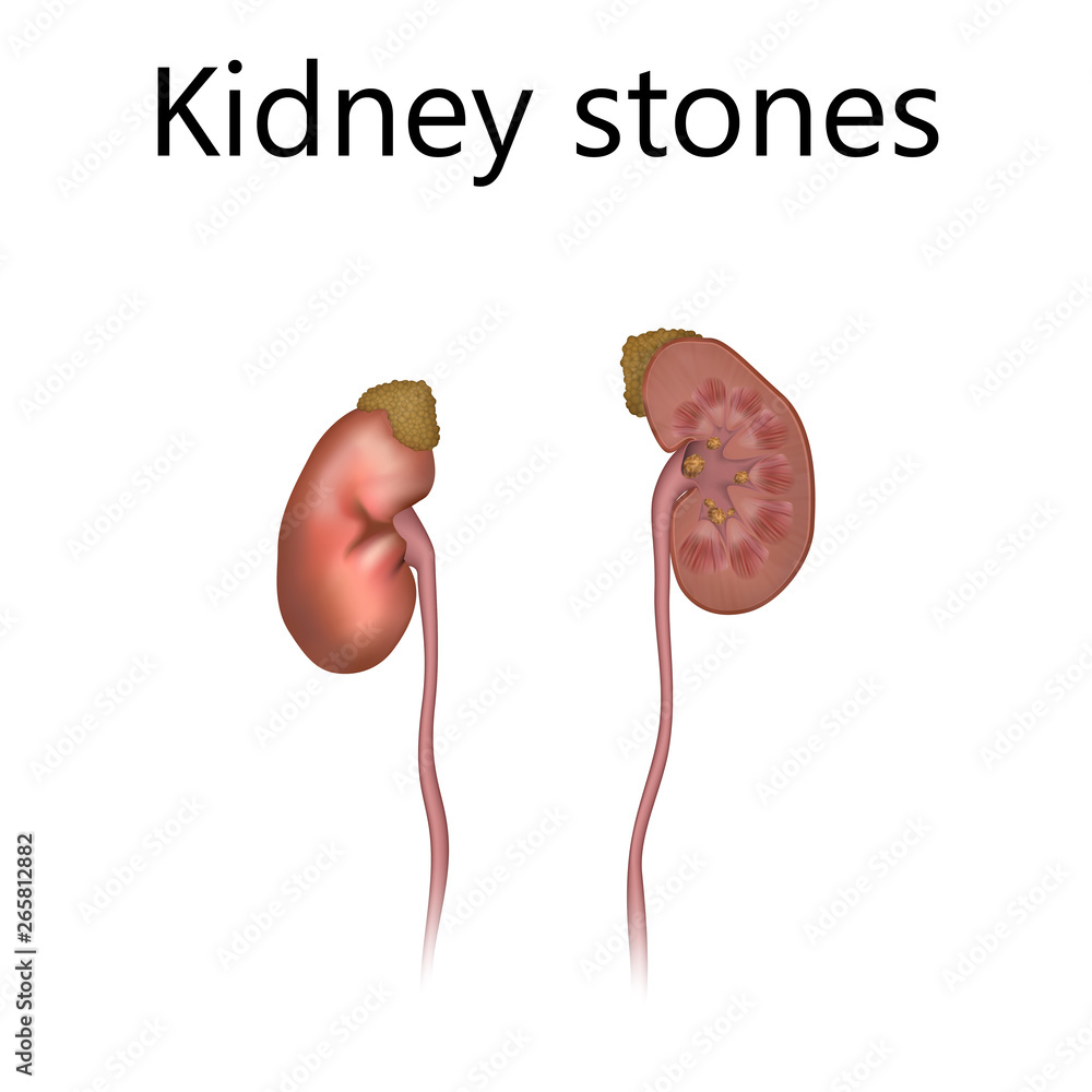 Kidney stones. Urolithiasis, renal lithiasis, nephrolithiasis, clumps ...