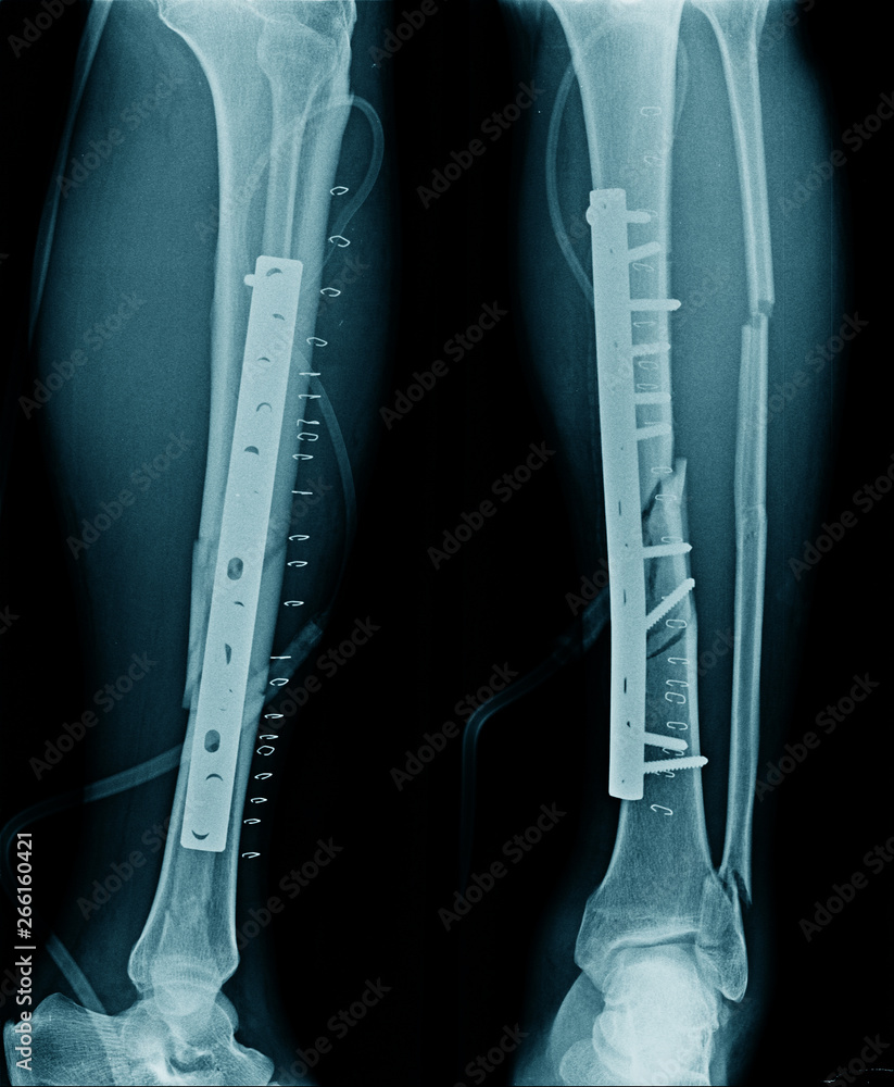 fracture tibia bone with post operation internal fixation Stock Photo ...