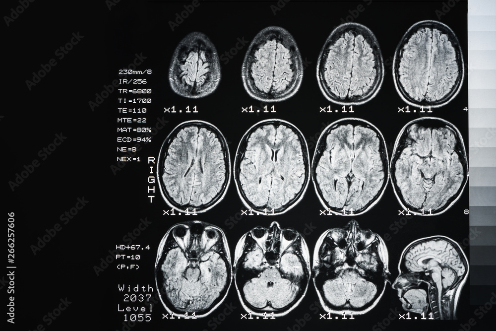 The result is an MRI of the brain with values and numbers. Medical ...