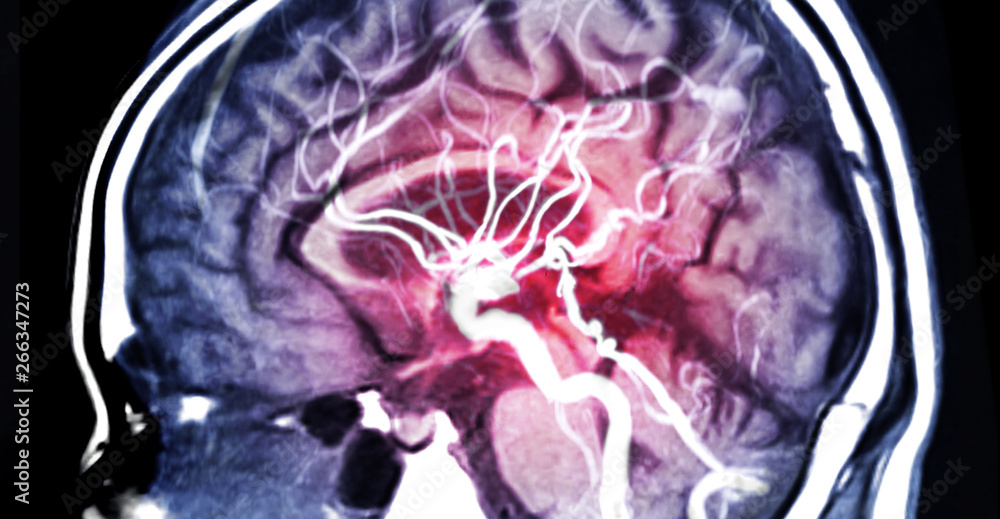 MRA Brain or Magnetic resonance angiography (MRI) of Vessel in the ...