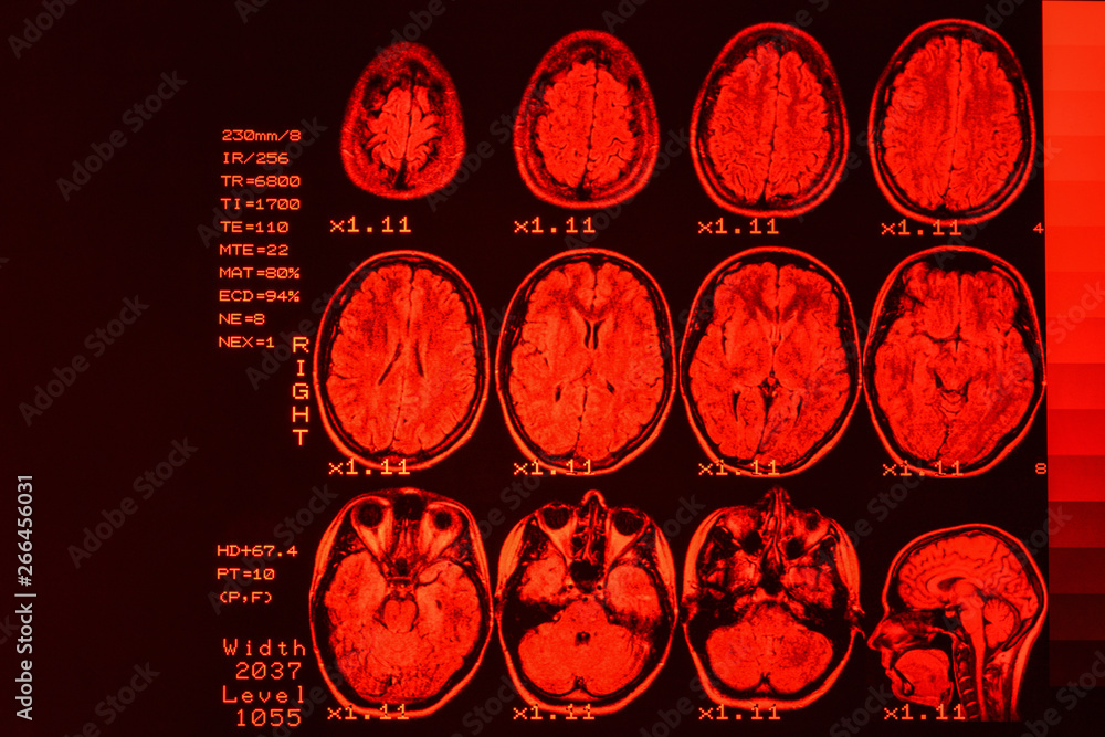 Foto de MRI scan or magnetic resonance image of head and brain scan ...