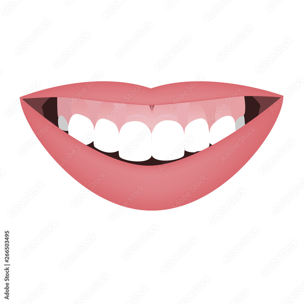 Vetor de Mouth with a distal bite and high smile line or gummy smile ...