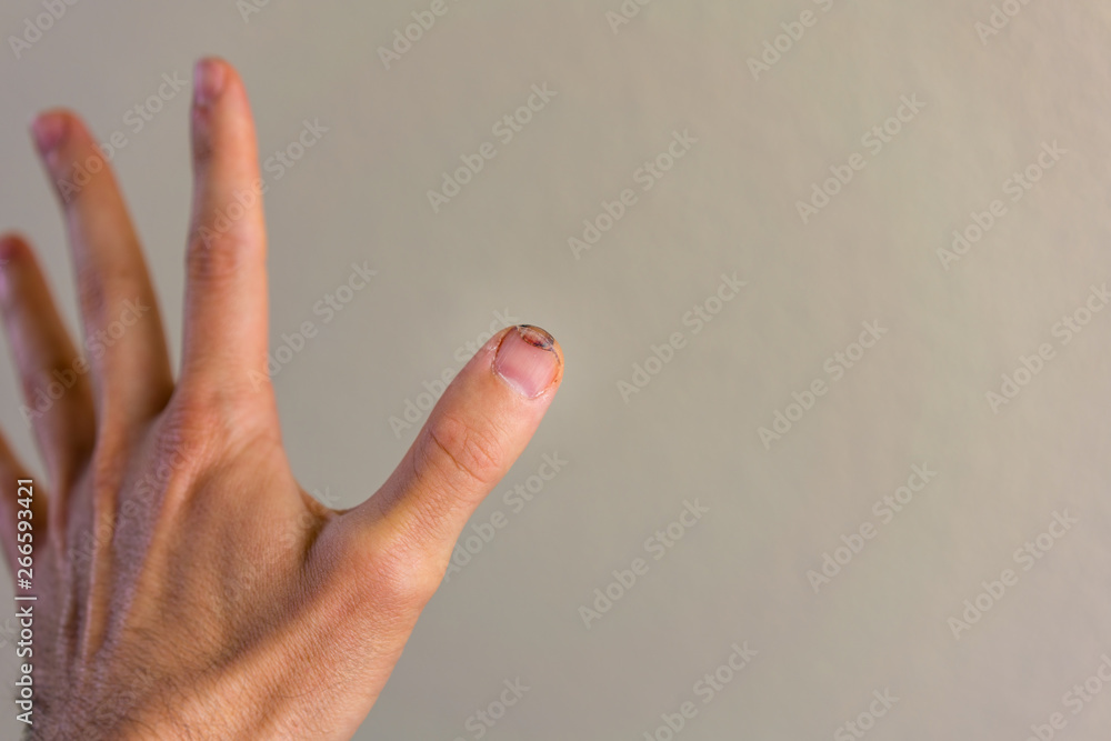 Thumb finger cut with sharp knife while cooking, home injury medical ...