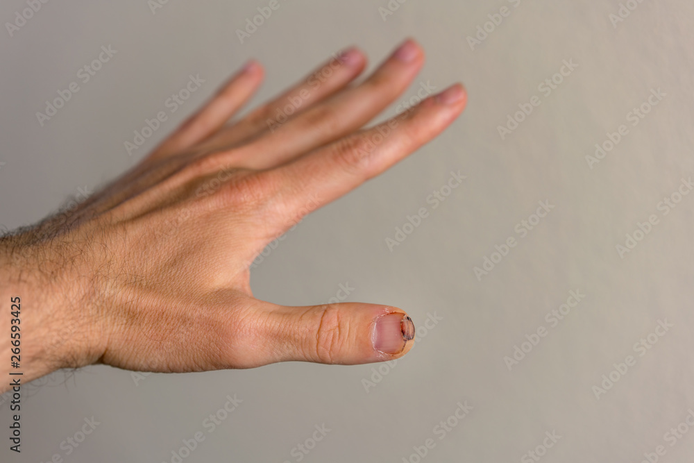 Thumb finger cut with sharp knife while cooking, home injury medical ...