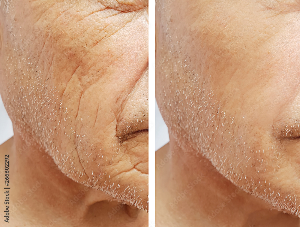 Elderly male face wrinkles before and after correction procedures Stock ...