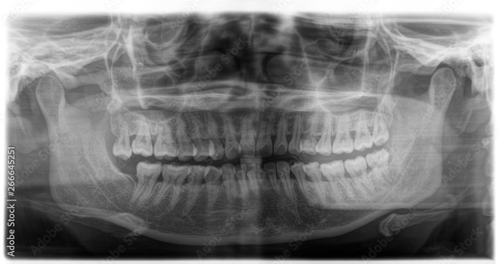 X ray of human mouth with teeth bones in black and white. Detail of ...