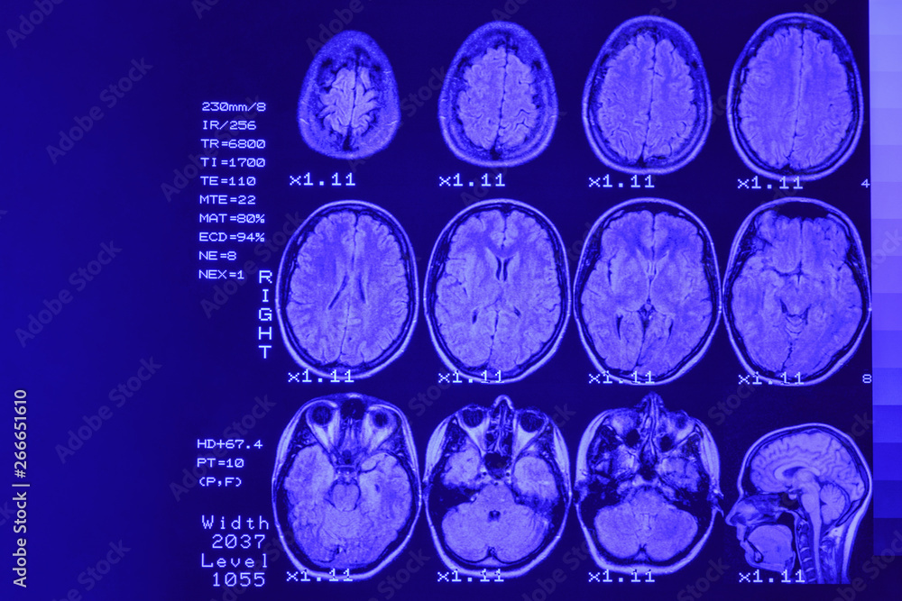 MRI scan or magnetic resonance image of head and brain scan. The result ...