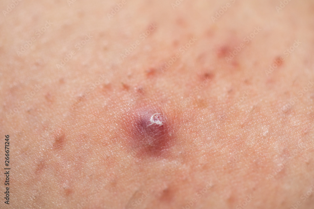 Painful folliculitis on female skin Stock Photo | Adobe Stock