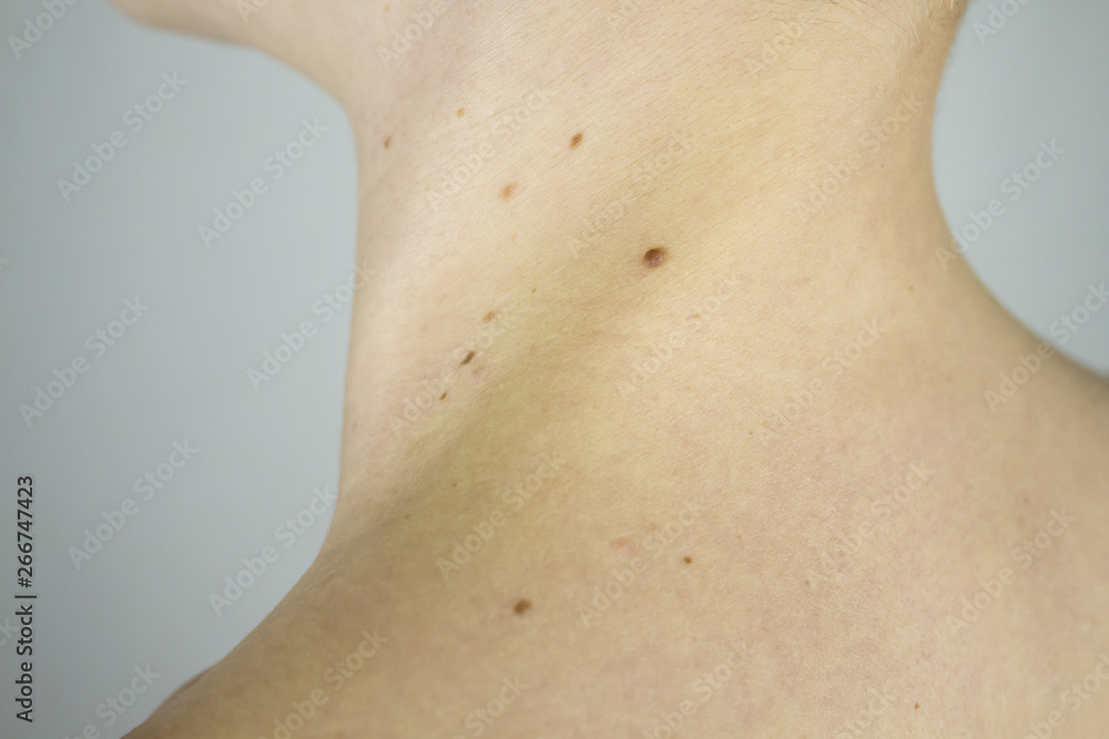 The shoulder and neck of the girl in the turn with a lot of moles on ...