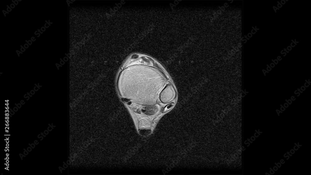 R.M.N. Nuclear magnetic resonance, of human foot, with cross-section ...