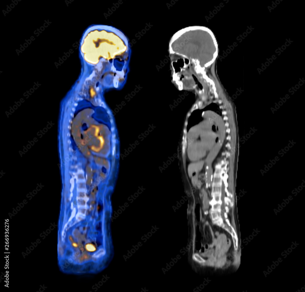 Foto de PET CT Scan image of whole body and CT scan Comparison in Sagittal plane of patient ...