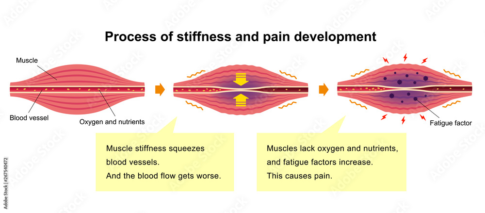 Cause of muscle's stiffness and pain illustration (with explanation ...