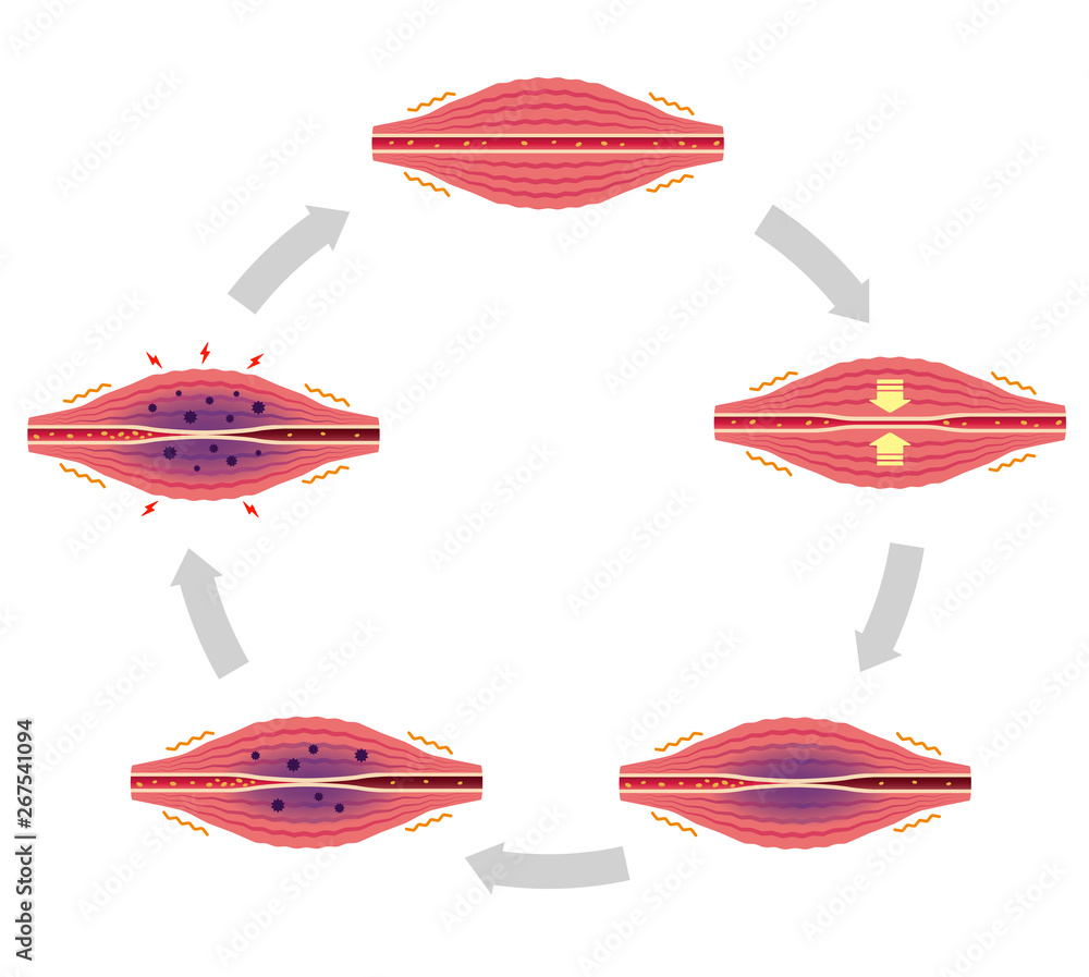 Cycle of stiffness and pain , and spiral of chronicification ...
