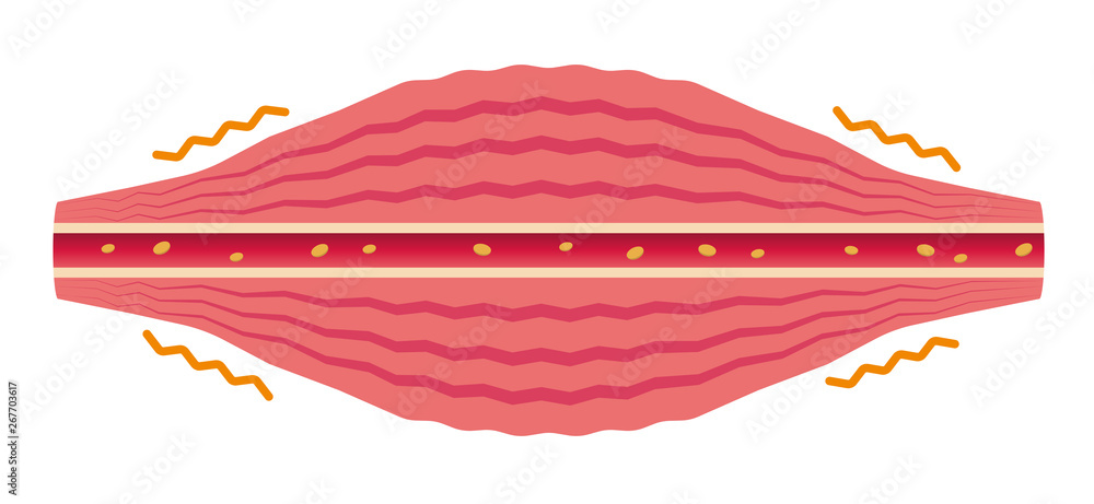 Muscle becomes tense (No text) . Flat illustration of muscle and vessel ...