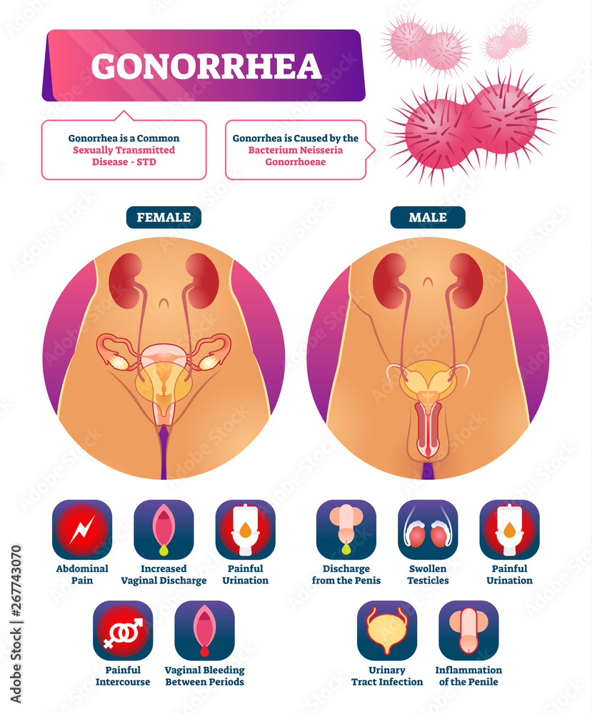 Gonorrhea vector illustration. Labeled STD disease explanation symptom list vector de Stock ...