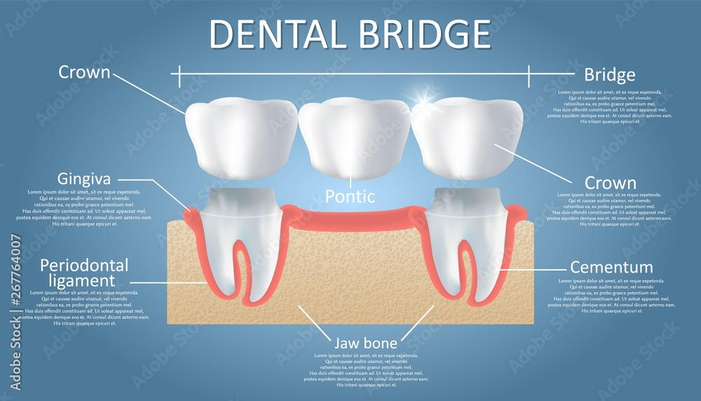 Vetor de Dental bridge concept vector educational poster, diagram do ...