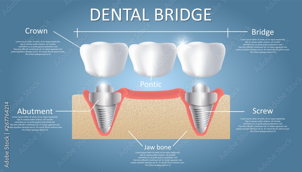 Dental bridge concept vector educational poster, diagram Stock Vector ...