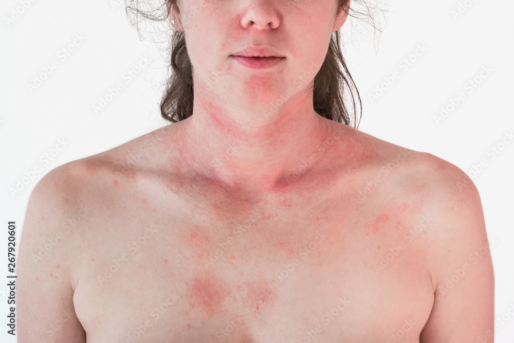Allergic Skin Reaction On The Female Neck And Face Red Rash Foto De