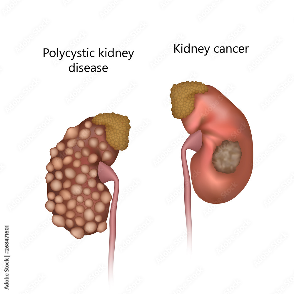Polycystic kidney disease, comparison with cancer. Tumor, with cysts ...
