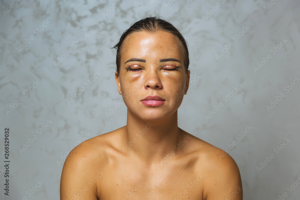 Woman after plastic surgery on the eyes. Stitches on the eyelids after ...