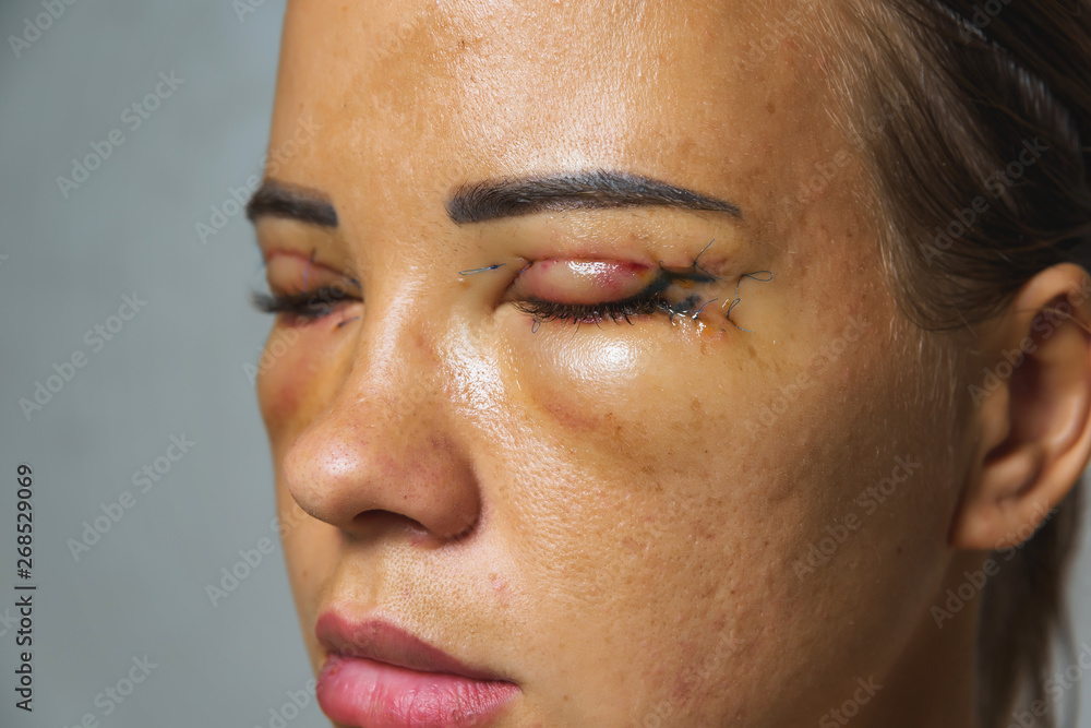 Woman after plastic surgery on the eyes. Stitches on the eyelids after ...
