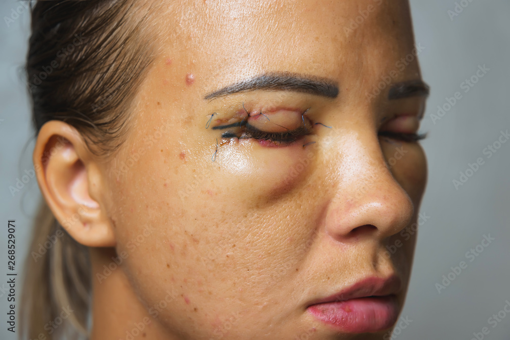 Woman after plastic surgery on the eyes. Stitches on the eyelids after ...