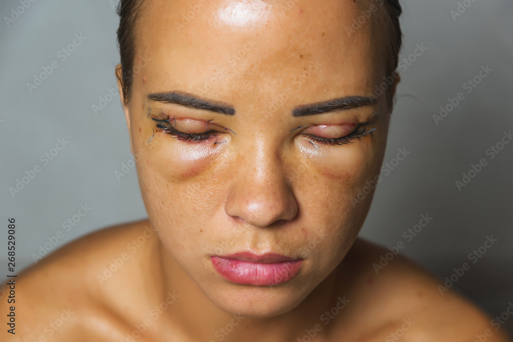 Woman after plastic surgery on the eyes. Stitches on the eyelids after ...