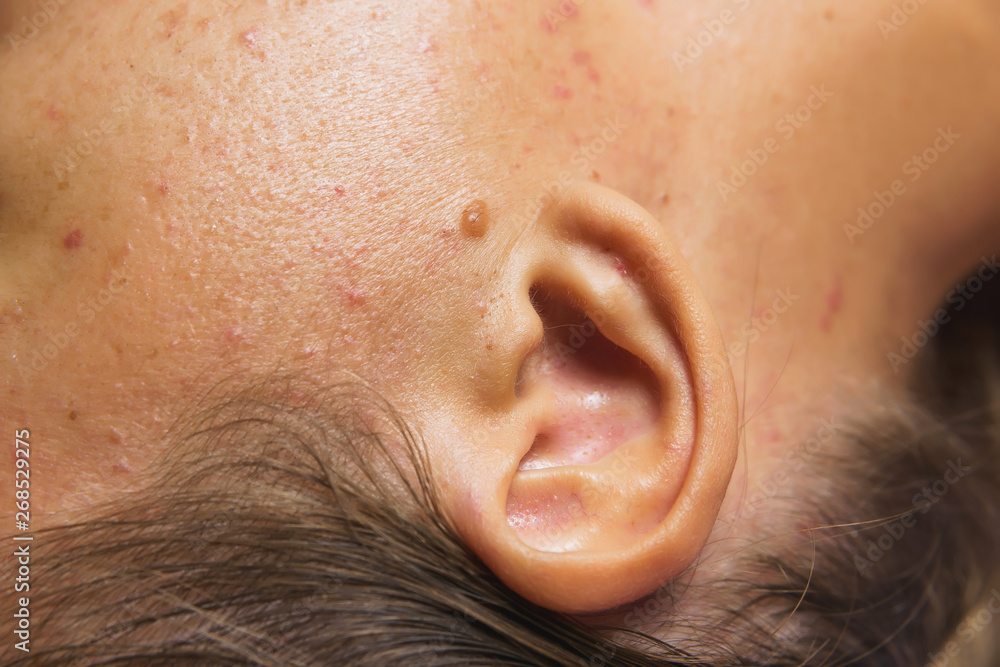 Acne and wen on the skin of the face near the ears close-up. Female ...