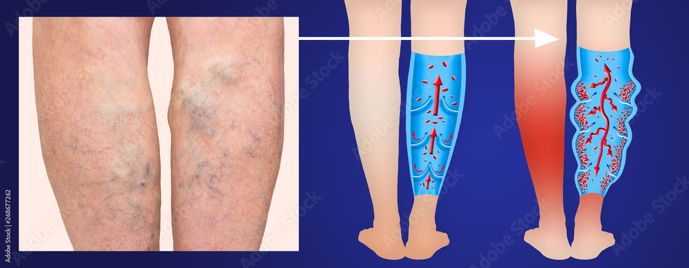 Varicose veins on a female senior legs. The structure of normal and ...