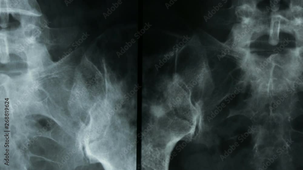 Zoom-in of the X-ray plate of the bones of the spine and the human ...