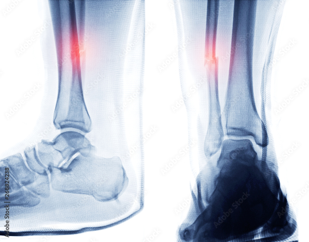 Ap Ankle X Ray Anatomy