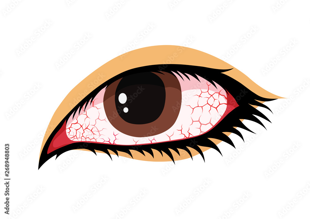 Red eye or cracked. Blood vessels and eyeball in cartoon vector style ...