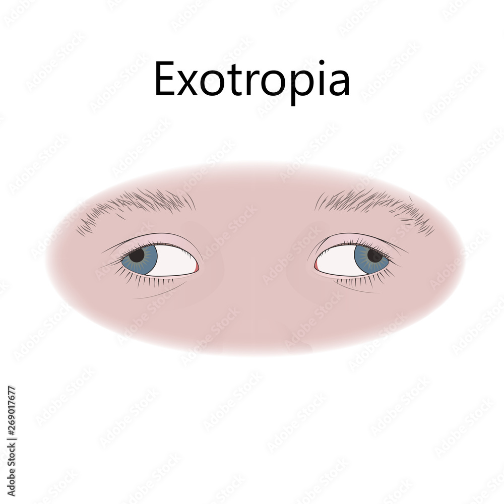 Strabismus in infants, child, kid. Exotropia, wall-eyed, outward eyes ...