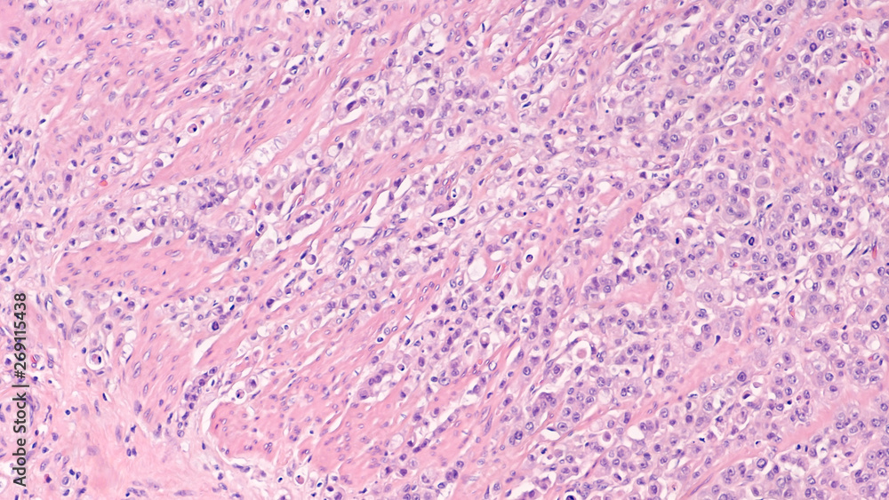 Poster Photomicrograph of stomach cancer (gastric adenocarcinoma ...