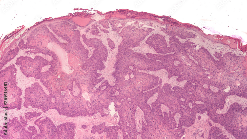 Squamous Cell Carcinoma Of The Lip Pictures - Infoupdate.org