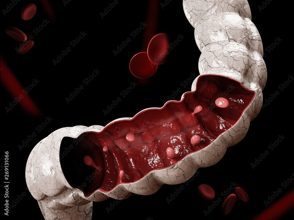 Colon polyps. 3d illustration, Polyp in the intestine. Stock ...