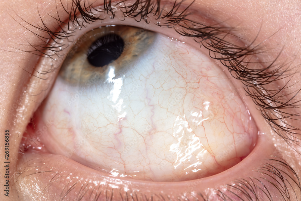 Red veins in the eye of a boy, Macro Stock Photo | Adobe Stock