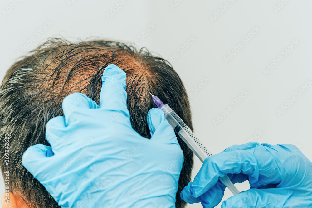 Mesotherapy of hair and head. Injections in the head. Fighting hair ...