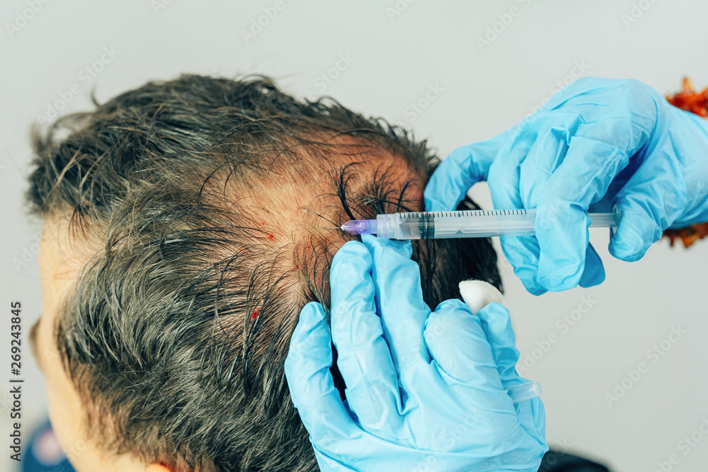 Mesotherapy of hair and head. Injections in the head. Fighting hair ...