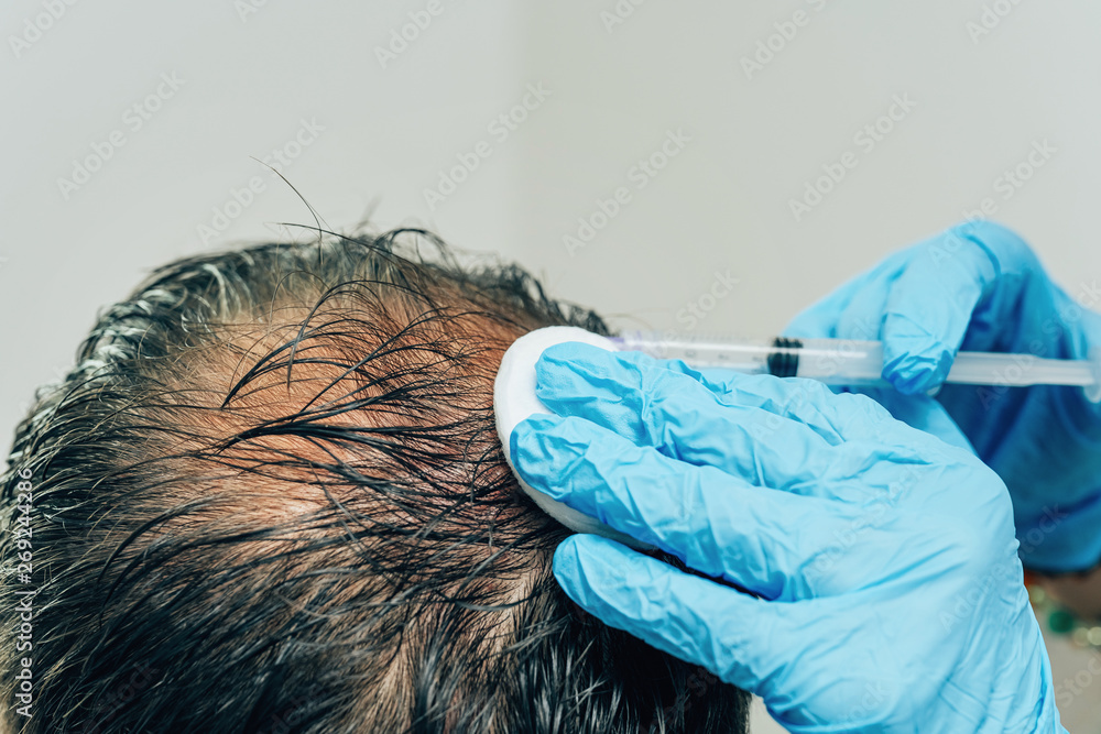 Mesotherapy of hair and head. Injections in the head. Fighting hair ...