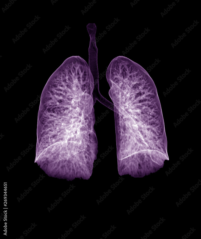 CT Chest or CT lung 3d rendering image with purple color showing ...